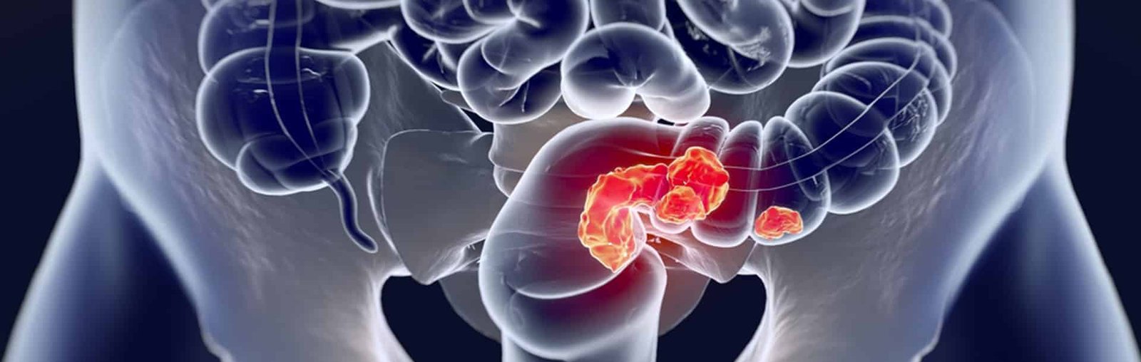 Καρκίνος Ορθού | Συμπτώματα, Στάδια & Οριστική Θεραπεία