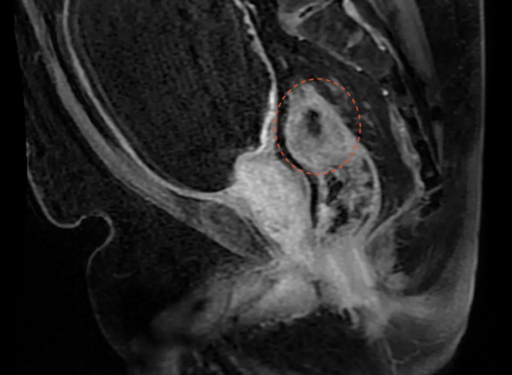Καρκίνος Ορθού | Συμπτώματα, Στάδια & Οριστική Θεραπεία