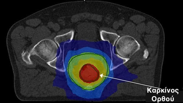 Καρκίνος Ορθού | Συμπτώματα, Στάδια & Οριστική Θεραπεία