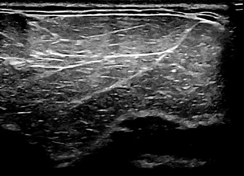 Λίπωμα | Αίτια, διάγνωση και θεραπεία - Κωνσταντίνος Γ. Αποστόλου MD ...