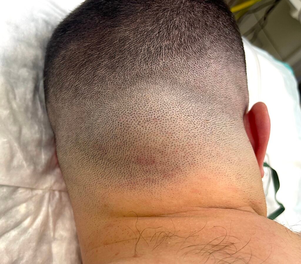 Λίπωμα | Αίτια, διάγνωση και θεραπεία - Κωνσταντίνος Γ. Αποστόλου MD ...