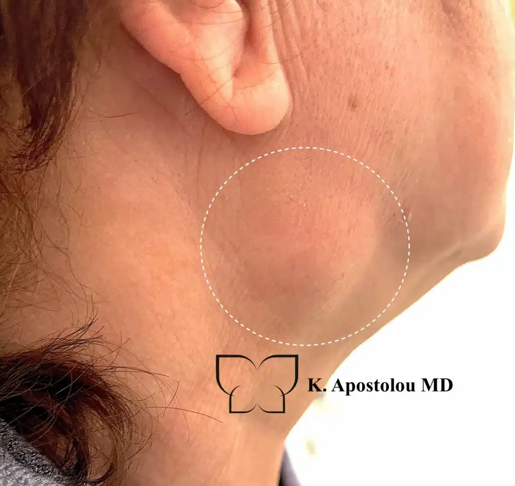 Λίπωμα | Αίτια, διάγνωση και θεραπεία - Κωνσταντίνος Γ. Αποστόλου MD ...