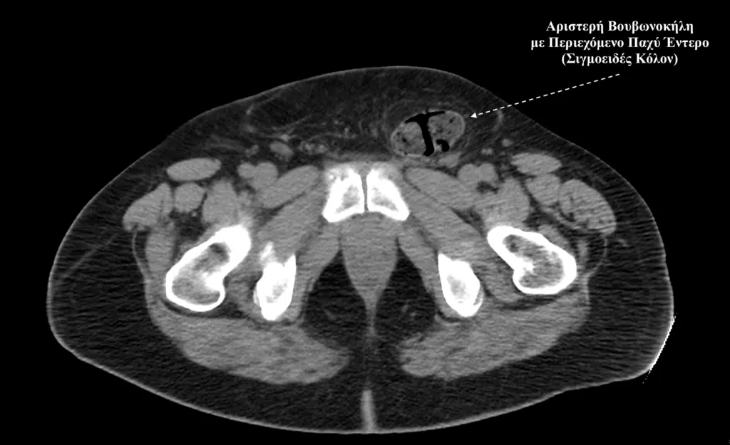 Βουβωνοκήλη: Συμπτώματα, Διάγνωση & Σύγχρονη Θεραπεία