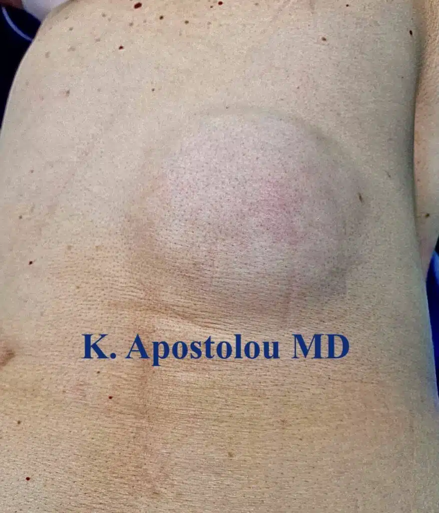 Λίπωμα | Αίτια, διάγνωση και θεραπεία - Κωνσταντίνος Γ. Αποστόλου MD ...